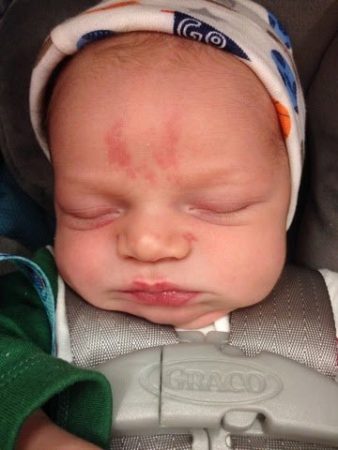 What are Stork Bites (Angel Kisses)? What causes them? Are there ...